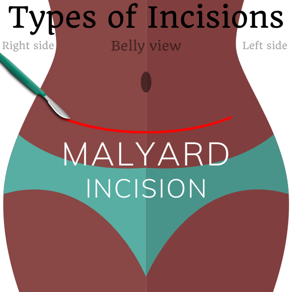 Types Of Surgical Incisions Sterilizationaunty