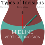 Types of surgical incisions - SterilizationAunty